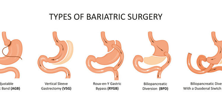 Pros And Cons Of Gastric Bypass Surgery What To Consider When Deciding